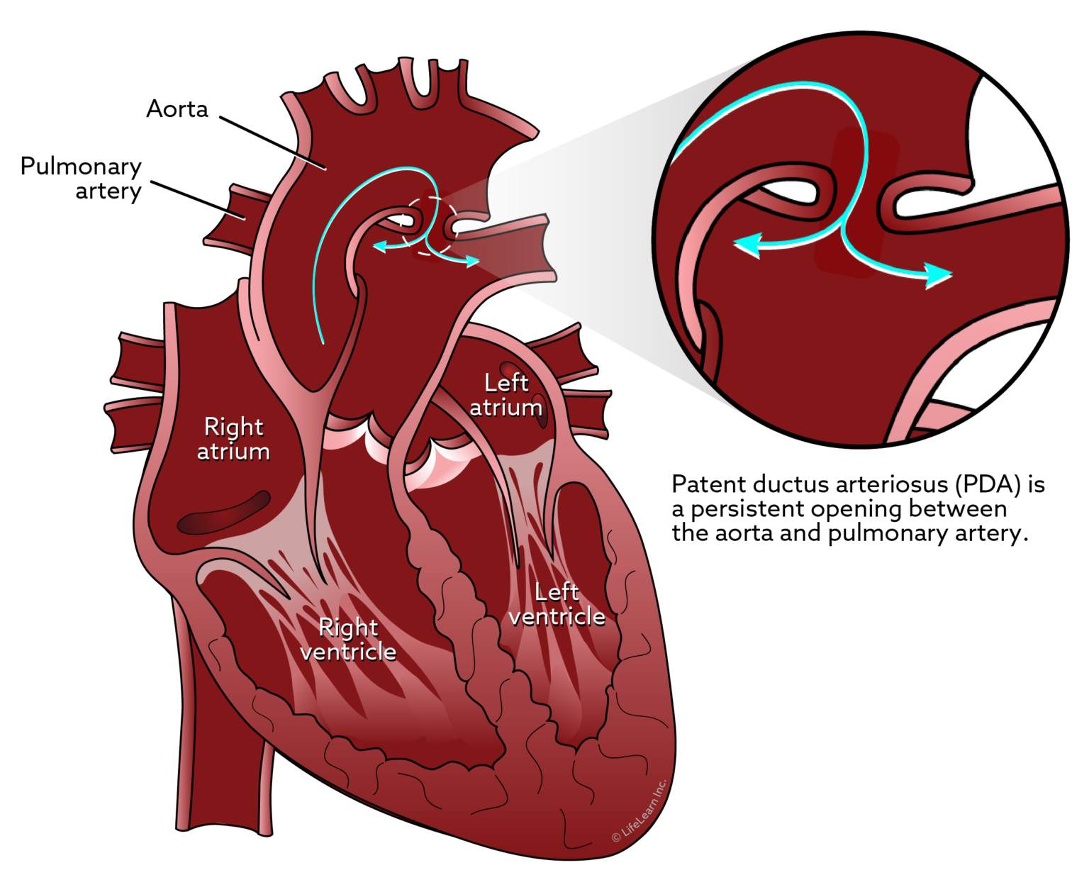 Patent Ductus Arteriosus (PDA) – SPA DU MAROC